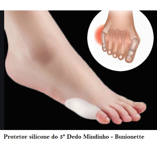 Protetor De Calo Joanete no Dedinho Mindinho Bunionette | Shopee Brasil