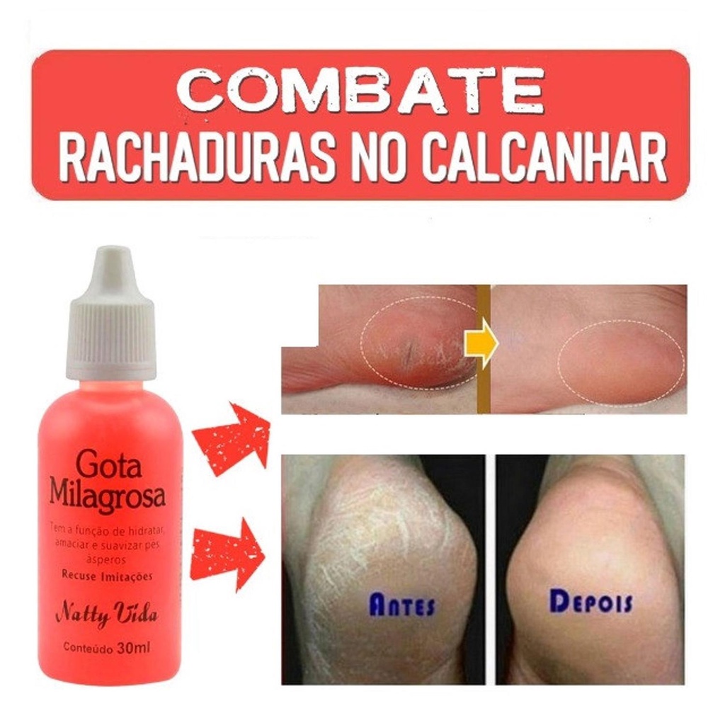 Gota Milagrosa Para Pés - Remedio Rachadura & Ressecamento - 30ml ...