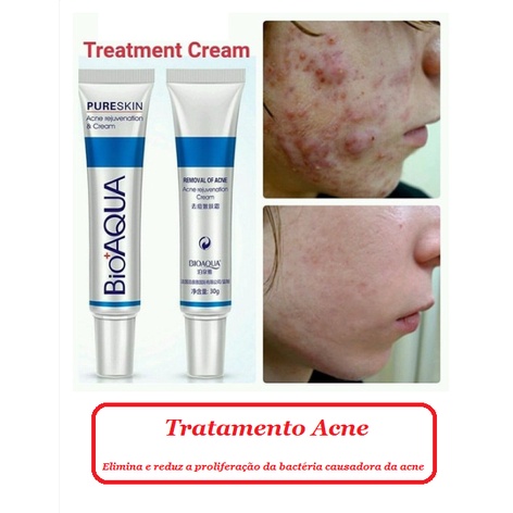 Pomada Para Espinha Acne Bioaqua Creme Anti Oleosidade Cravos Manchas E Melasma | Shopee Brasil
