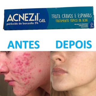Kit 3 Pomada para Acne Acnezil Gel 20g Tratamento Para Cravos Espinhas | Shopee Brasil