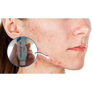 Clindoxyl Control 5% gel 45g - Tratamento da Acne | Shopee Brasil