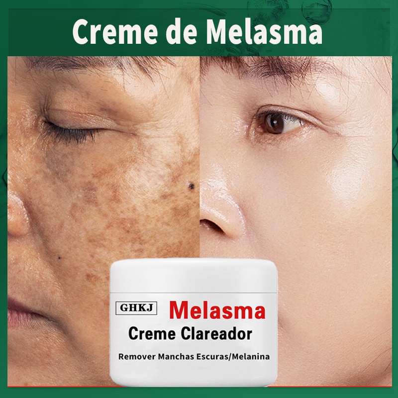 Creme Clareador Para Remover Melasma/ Manchas Escuras/ Melanina/Removedor De Acne/ Removedor de ...
