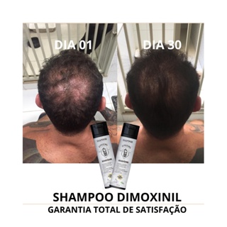 SHAMPOO DIMOXINIL - BLOQUEADOR DO DHT, ACABA COM A SEBORREIA, EFEITO ...