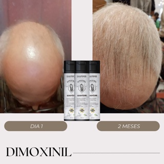 SHAMPOO DIMOXINIL - BLOQUEADOR DO DHT, ACABA COM A SEBORREIA, EFEITO ...