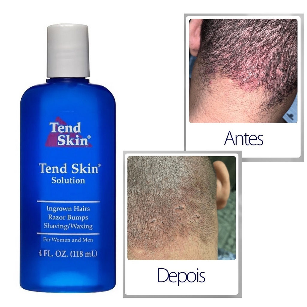 Tend Skin 118ml - Loção Para Pelos Encravados E Foliculite - Escorrega ...